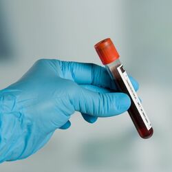 Ematocrito: Esami - Ematologia | Pazienti.it