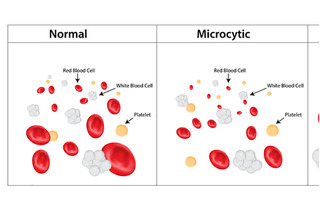 Microcitosi: Cos'è, Cause, Sintomi, Diagnosi, Cura | Pazienti.it
