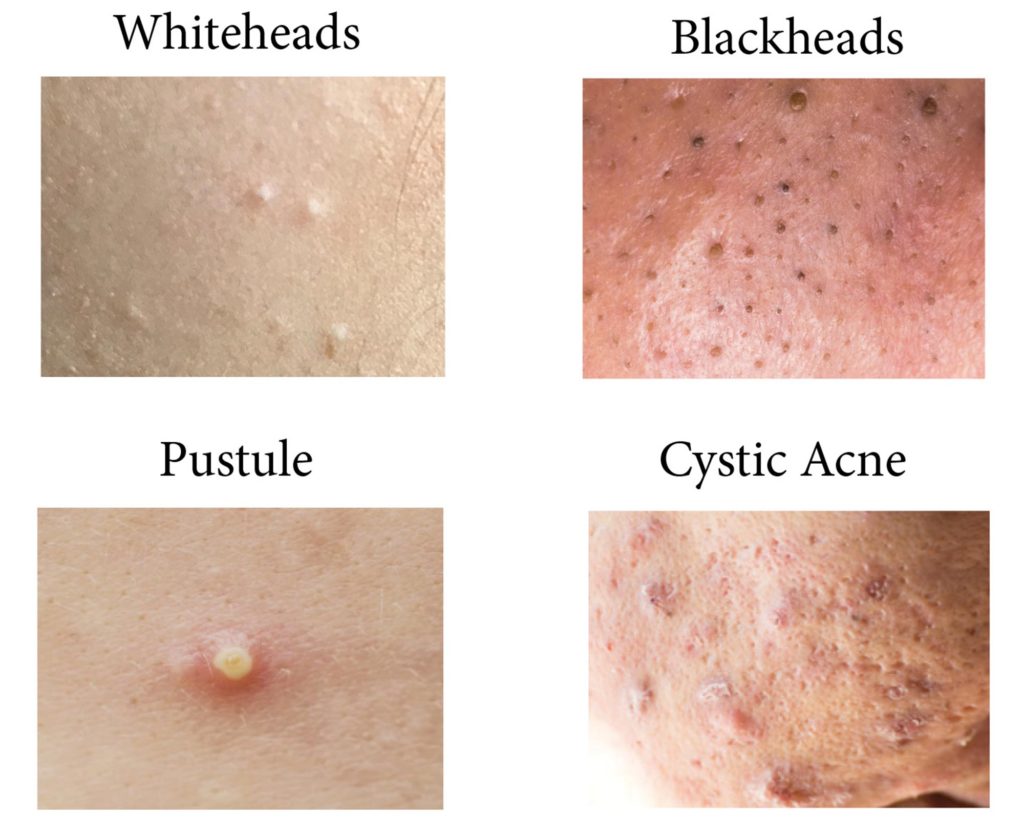 Acne Symptoms Causes And Treatments Acne Symptoms Causes And Treatments